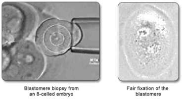 Preimplantation Genetic Diagnosis PGD With FISH