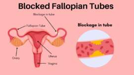 7 Steps to Getting Pregnant With Blocked Fallopian Tubes | Fertile Tree