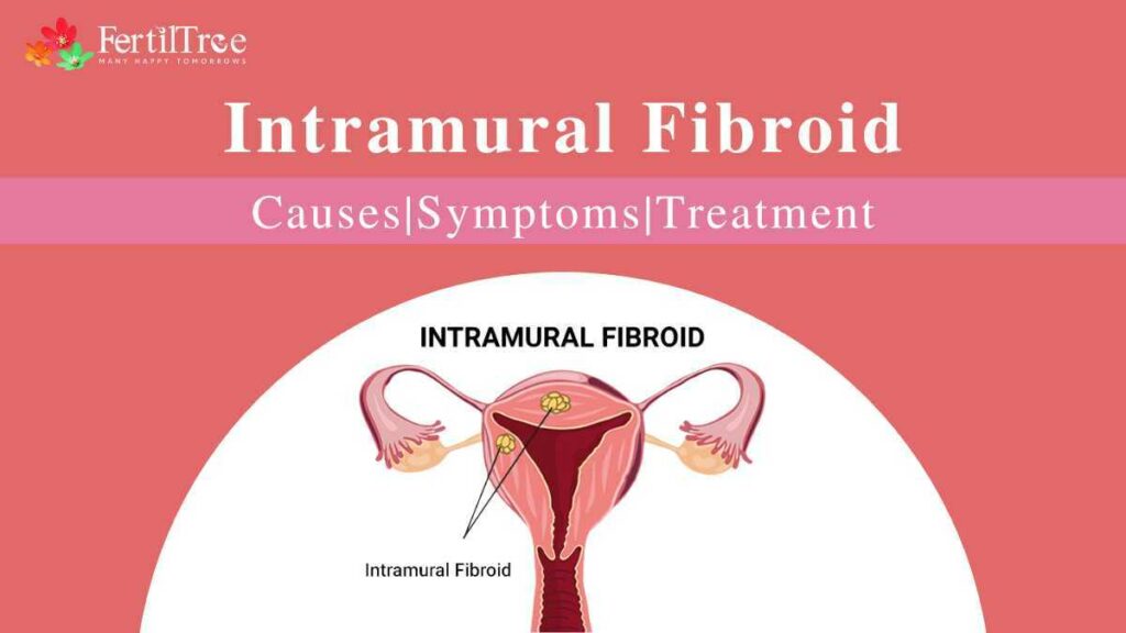 Intramural Fibroid - Causes, Symptoms & Treatment | FertilTree