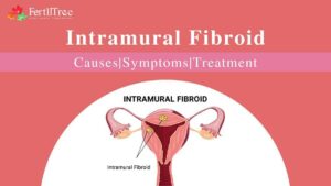 Intramural Fibroid - Causes, Symptoms & Treatment | FertilTree