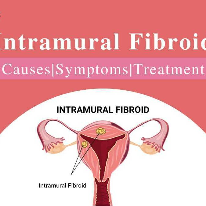 Fibroid Symptoms And Treatment
